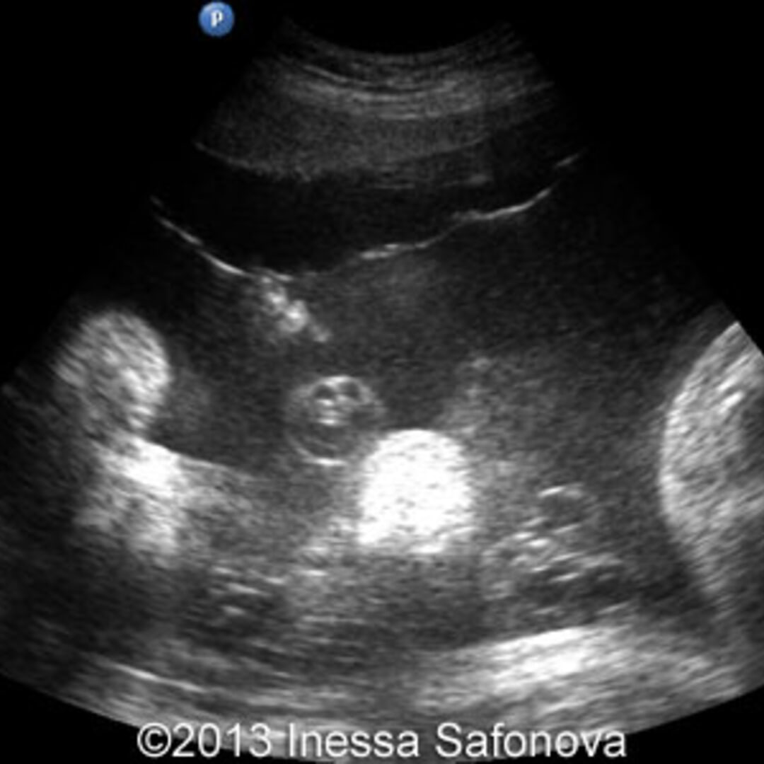 📃 Fetal akinesia deformation sequence