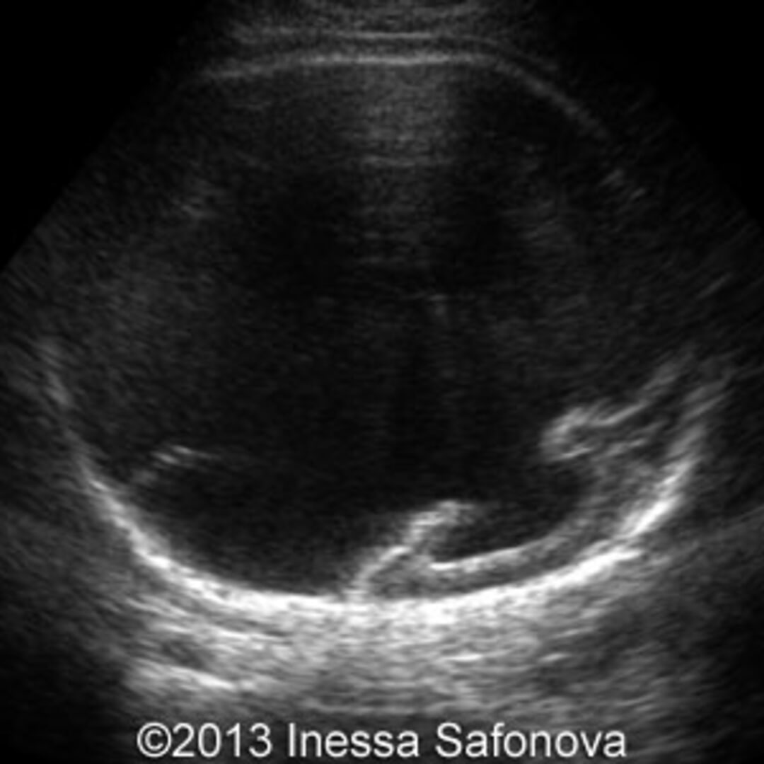 📃 Trisomy 13, two cases