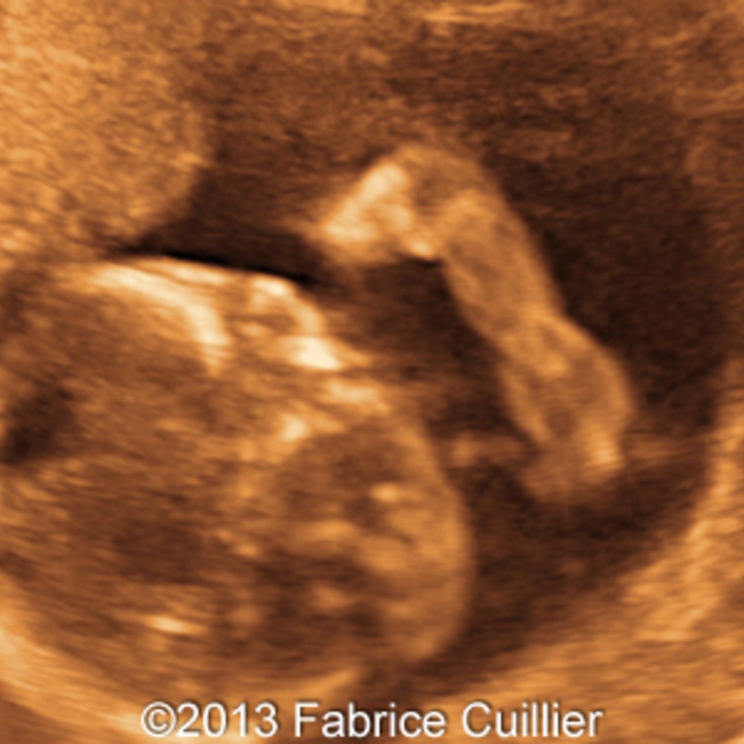 📃 Absent hand with digital nubbins