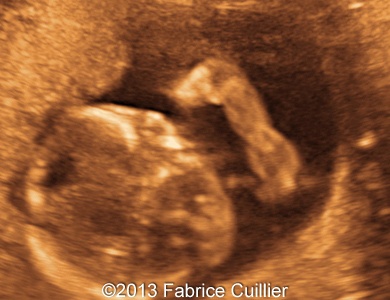 📃 Absent hand with digital nubbins