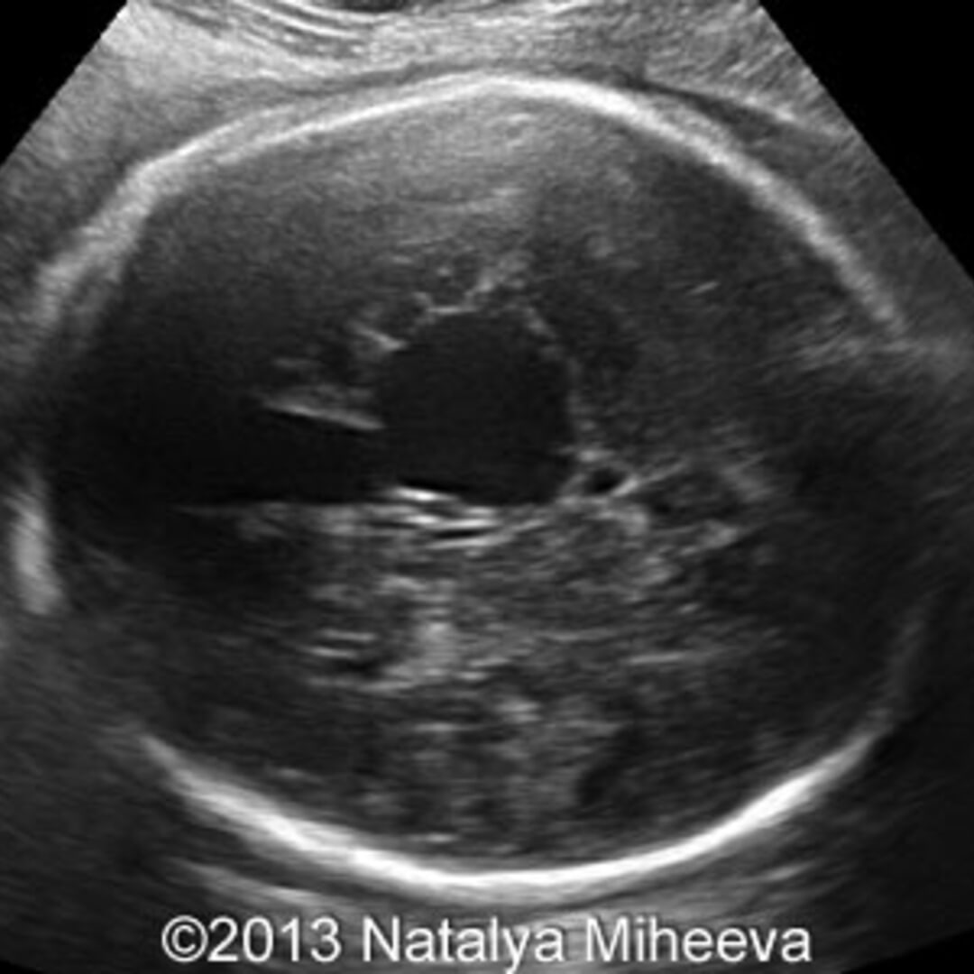 📃 Vein of Galen malformation