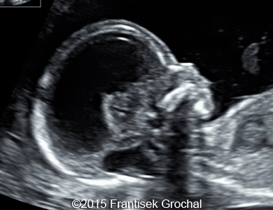 📃 Dandy-Walker syndrome