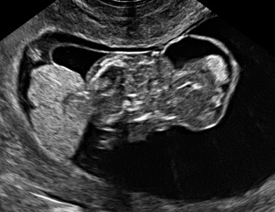 📃 Pentalogy of Cantrell, iniencephaly, acrania