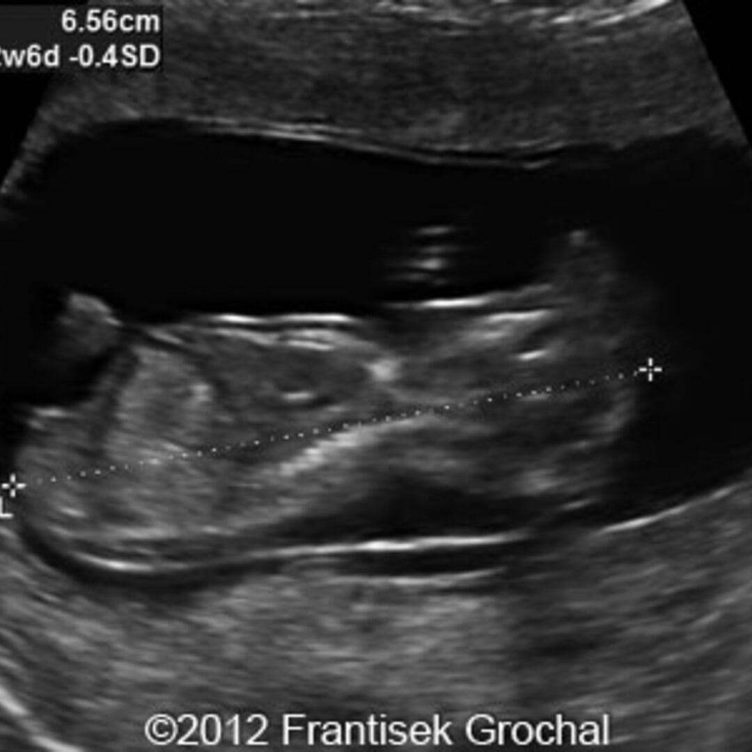 📃 Acrania, polydactyly, 13 weeks