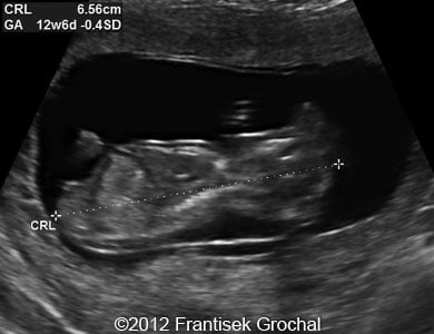📃 Acrania, polydactyly, 13 weeks
