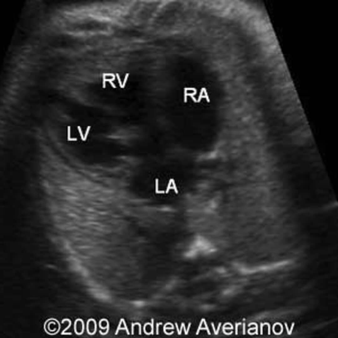 📃 Tricuspid atresia, ventricular septal defect and interrupted aortic arch