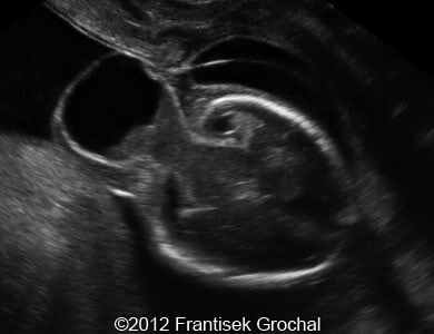 📃 Iniencephaly, 15 weeks