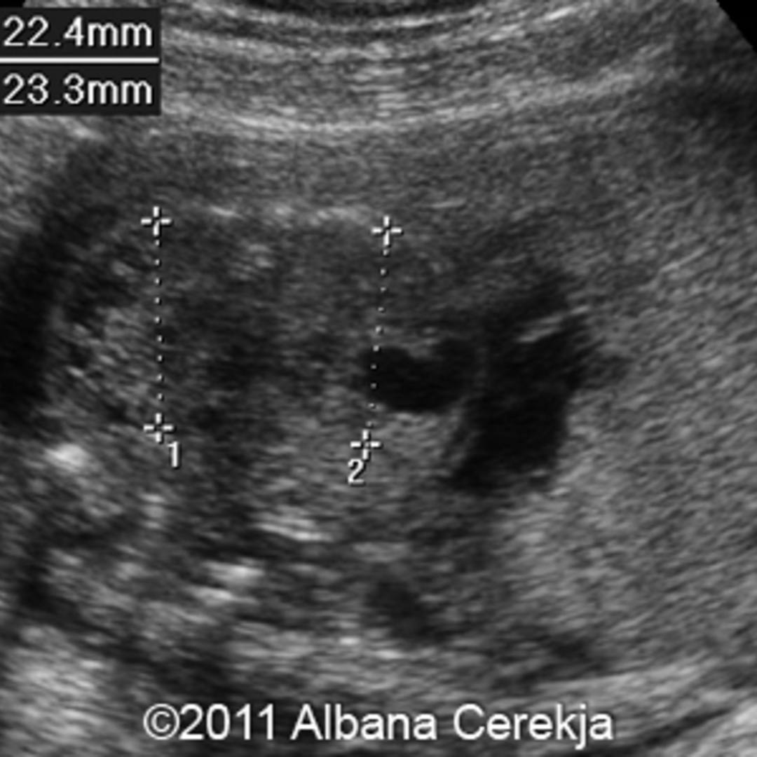 📃 Multicystic dysplastic kidneys, bilateral