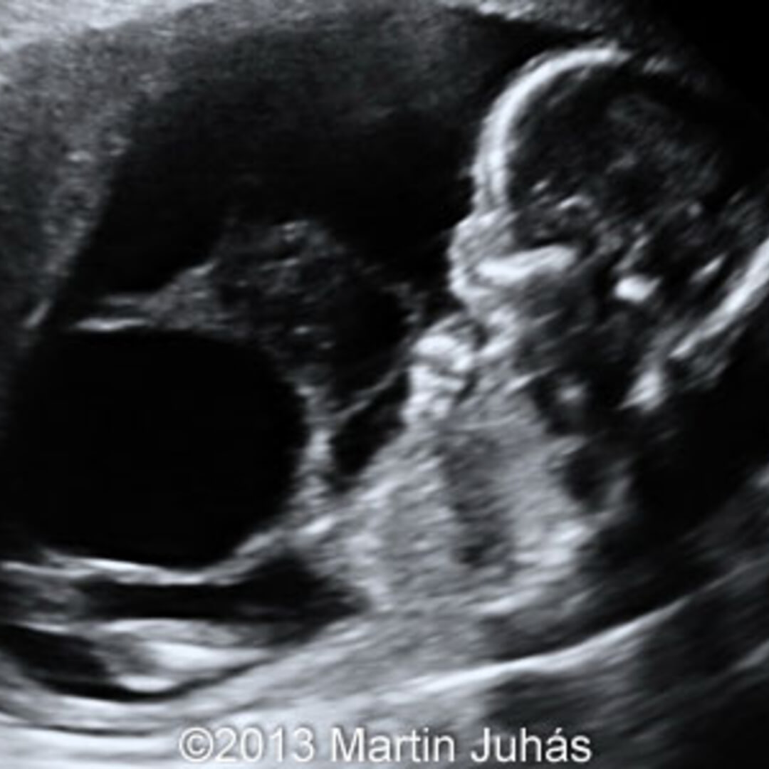 bladder exstrophy male