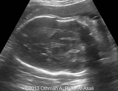 📃 Craniosynostosis with turricephaly, oxycephaly