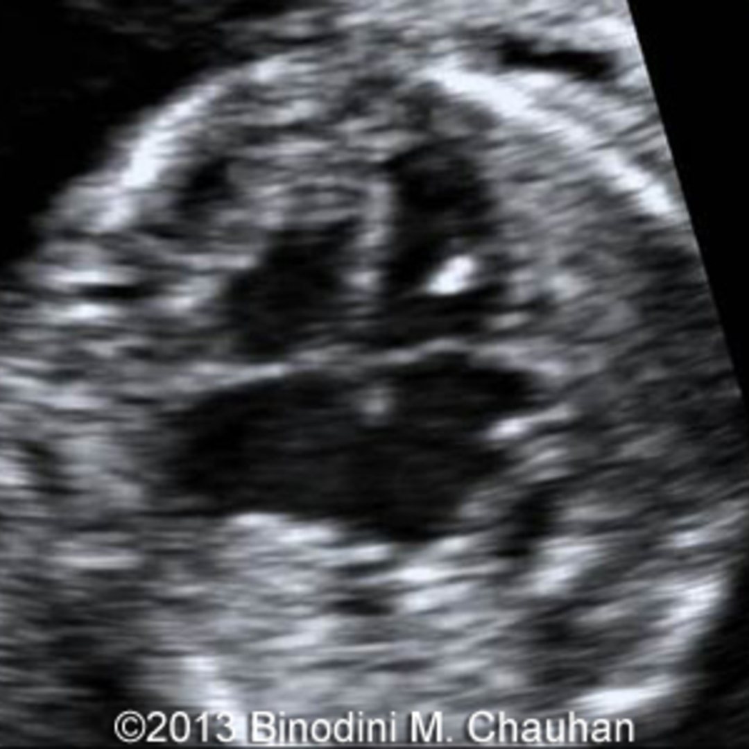fetal ductus venosus radiology