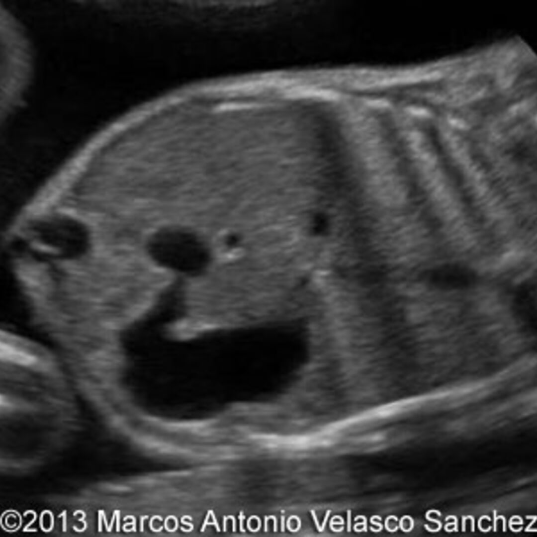 📃 Duodenal Atresia