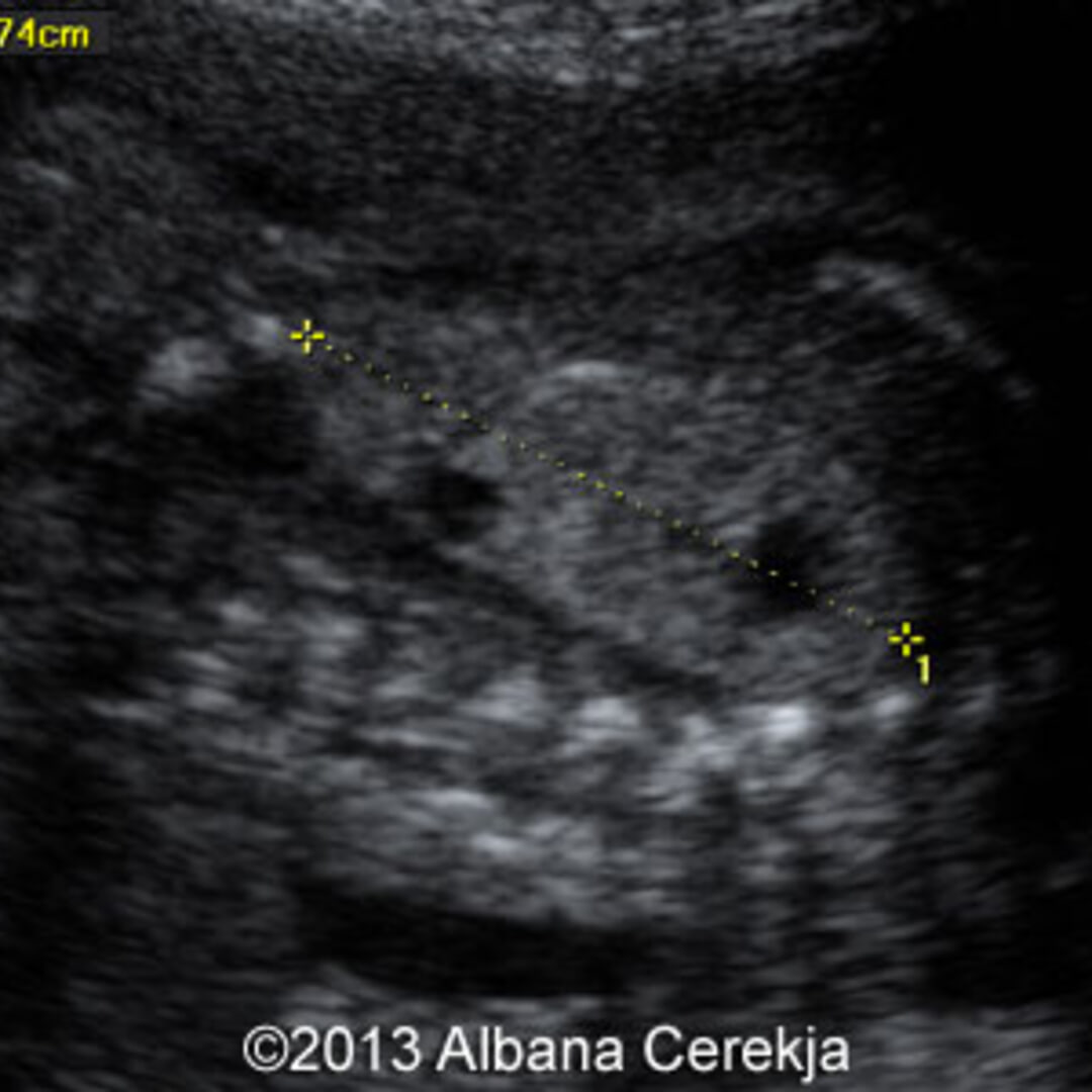 📃 Multicystic dysplastic kidney, unilateral