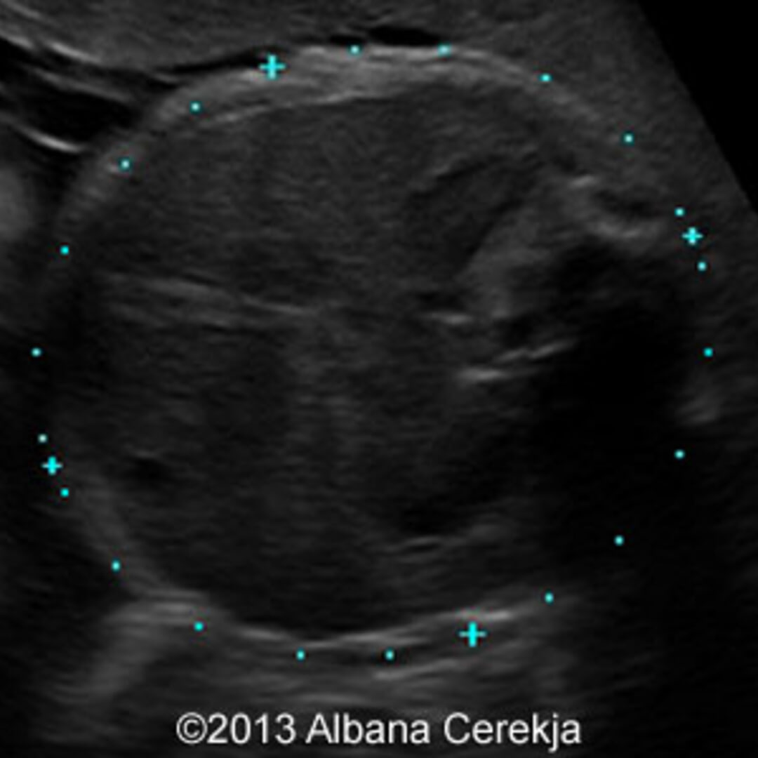 📃 Adenomyomatosis of the gallbladder