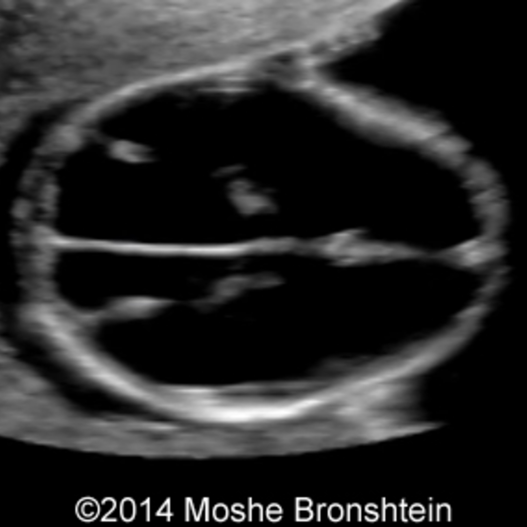 Severe Hydrocephalus In Fetus