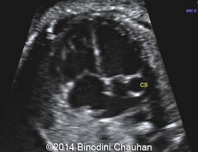 📃 Persistent left superior vena cava and absent right superior vena cava