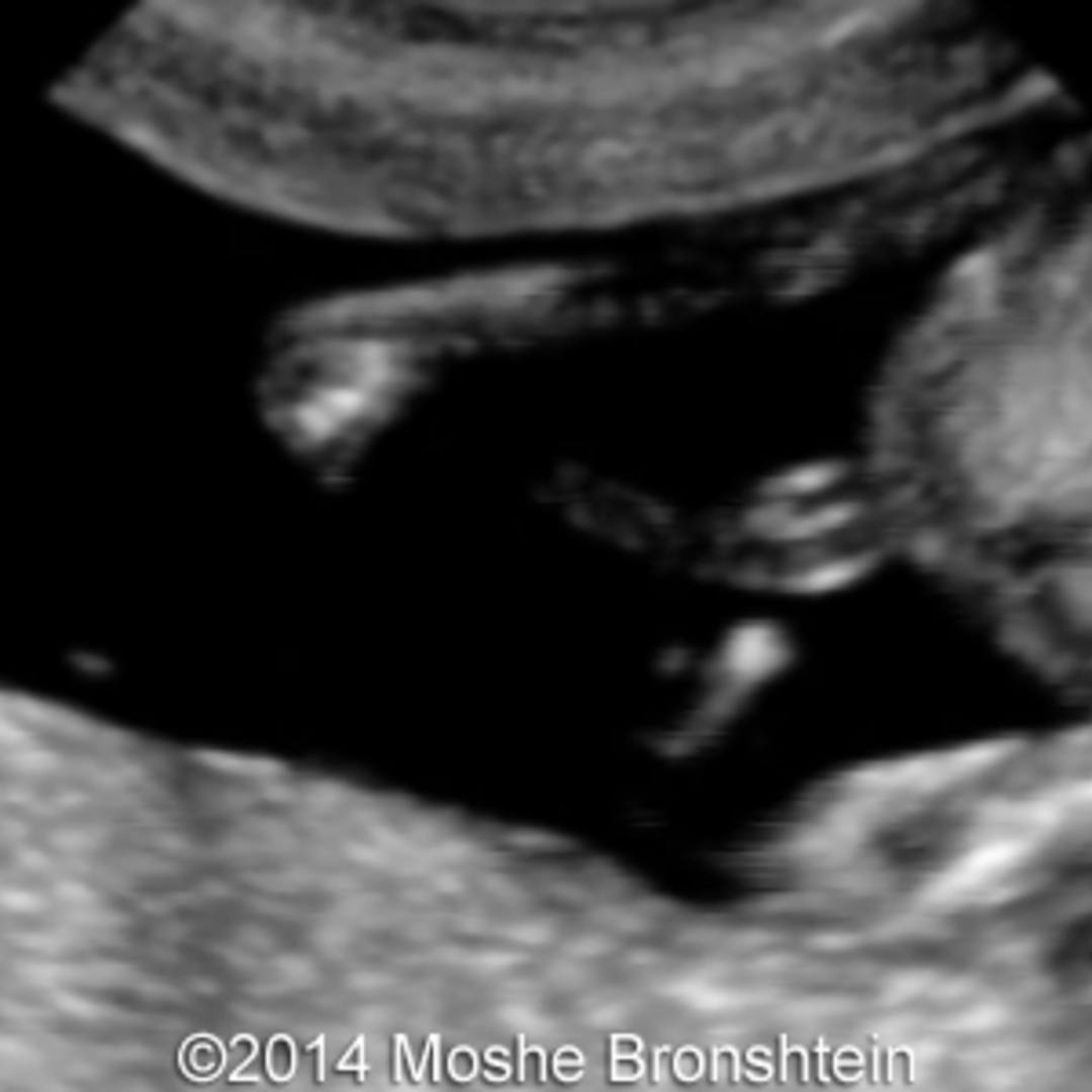 📃 Thrombocythemia absent radius syndrome