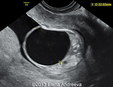 Oeis Complex Prenatal Ultrasound And Autopsy Findings Key Anatomic