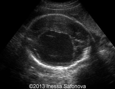📃 Giant fetal brain cyst with good perinatal result