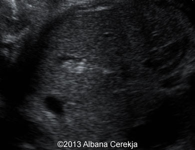 📃 Fetal biliary sludge, 2 cases
