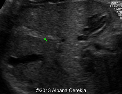 📃 Fetal biliary sludge, 2 cases