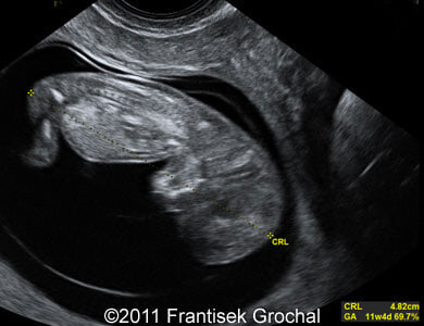 trisomy 21 scan