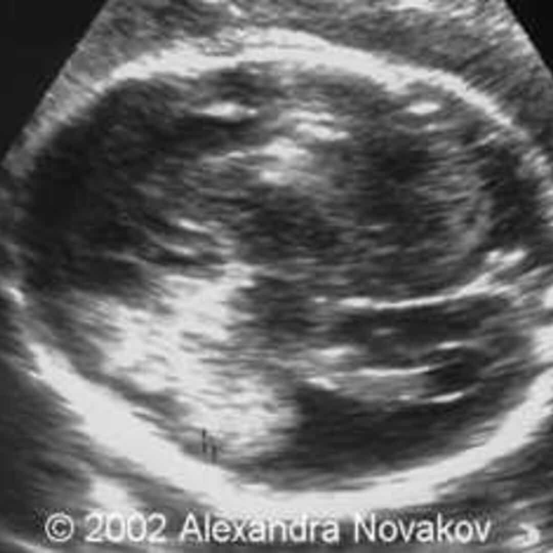 📃 Porencephalic cysts, multiple