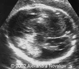 📃 Porencephalic cysts, multiple