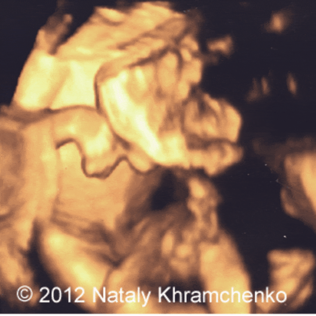 📃 Arthrogryposis or arthrogryposis multiplex congenita (AMC)