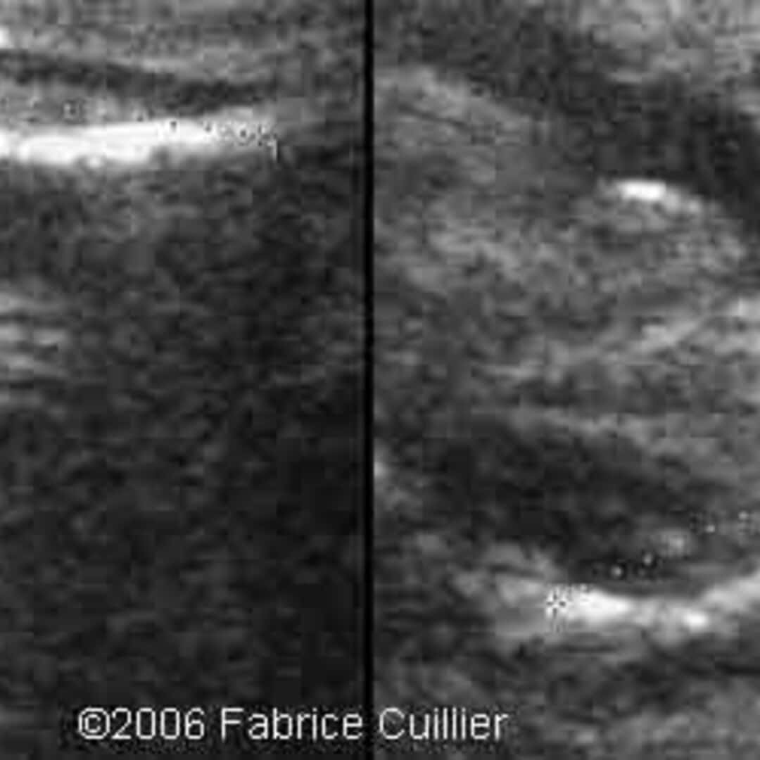 📃 Unilateral femoral hypoplasia