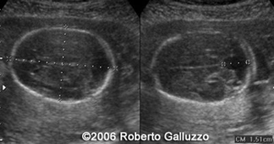 📃 Dandy Walker malformation