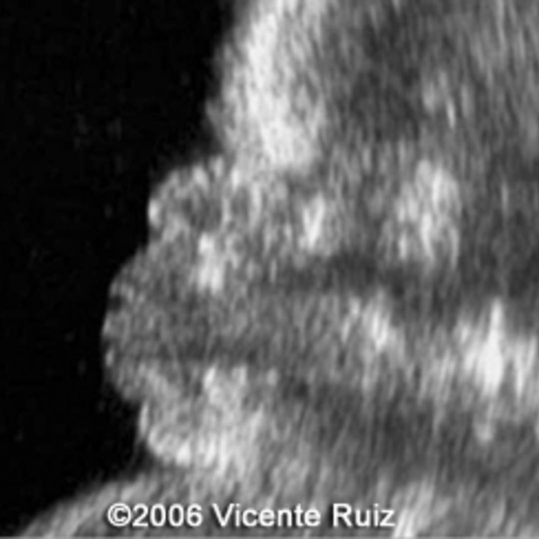 📃 Macroglossia