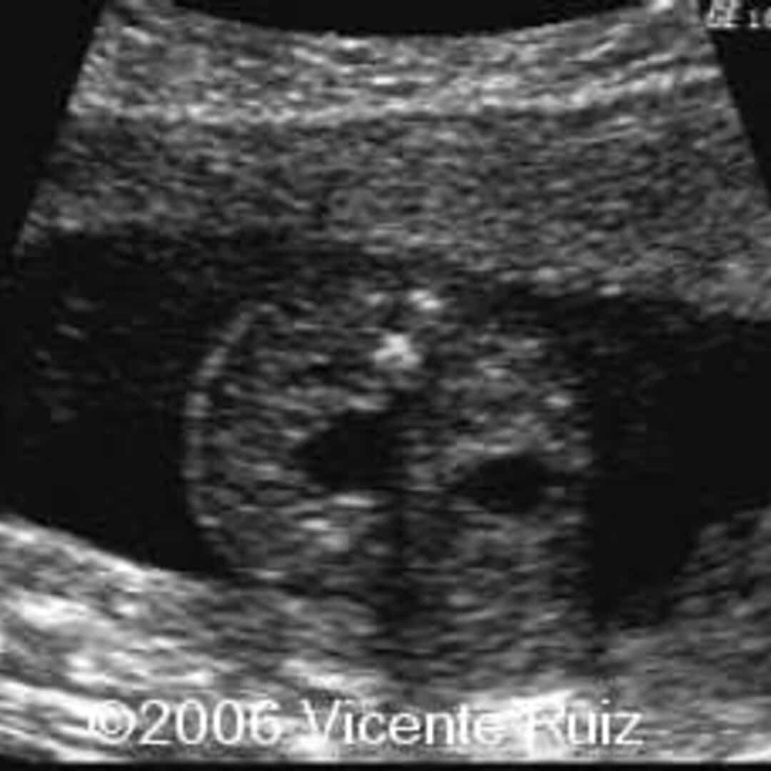 📃 Choledochal cyst