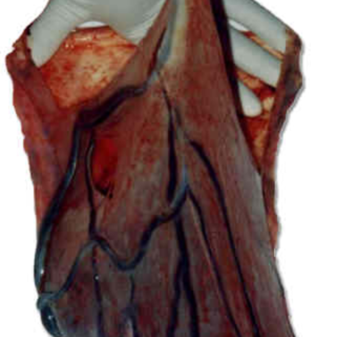📃 Cord, velamentous insertion