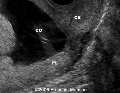 📃 Cord, eccentric insertion