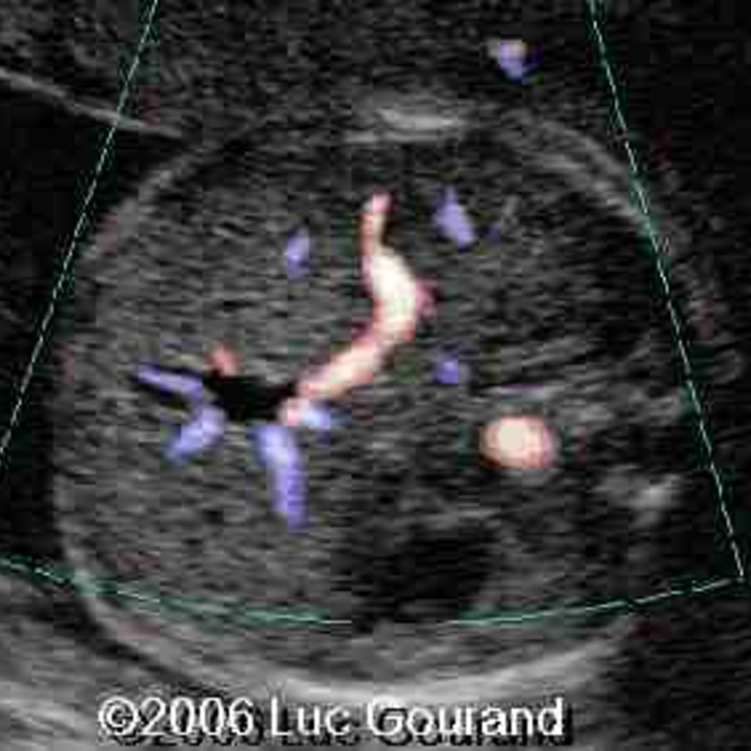 📃 Gallbladder, non-visualization