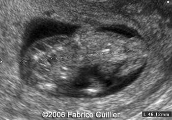 📃 Pentalogy of Cantrell, 11 weeks