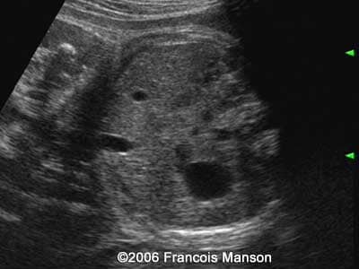 📃 Gallbladder, hypoplasia