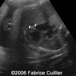 📃 Fetal valproate syndrome