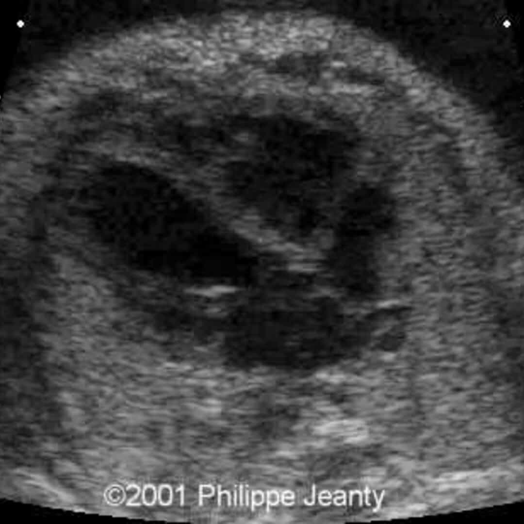 📃 Ebstein"s anomaly