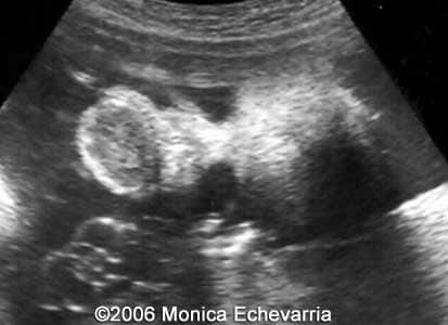 Epulis Pregnancy