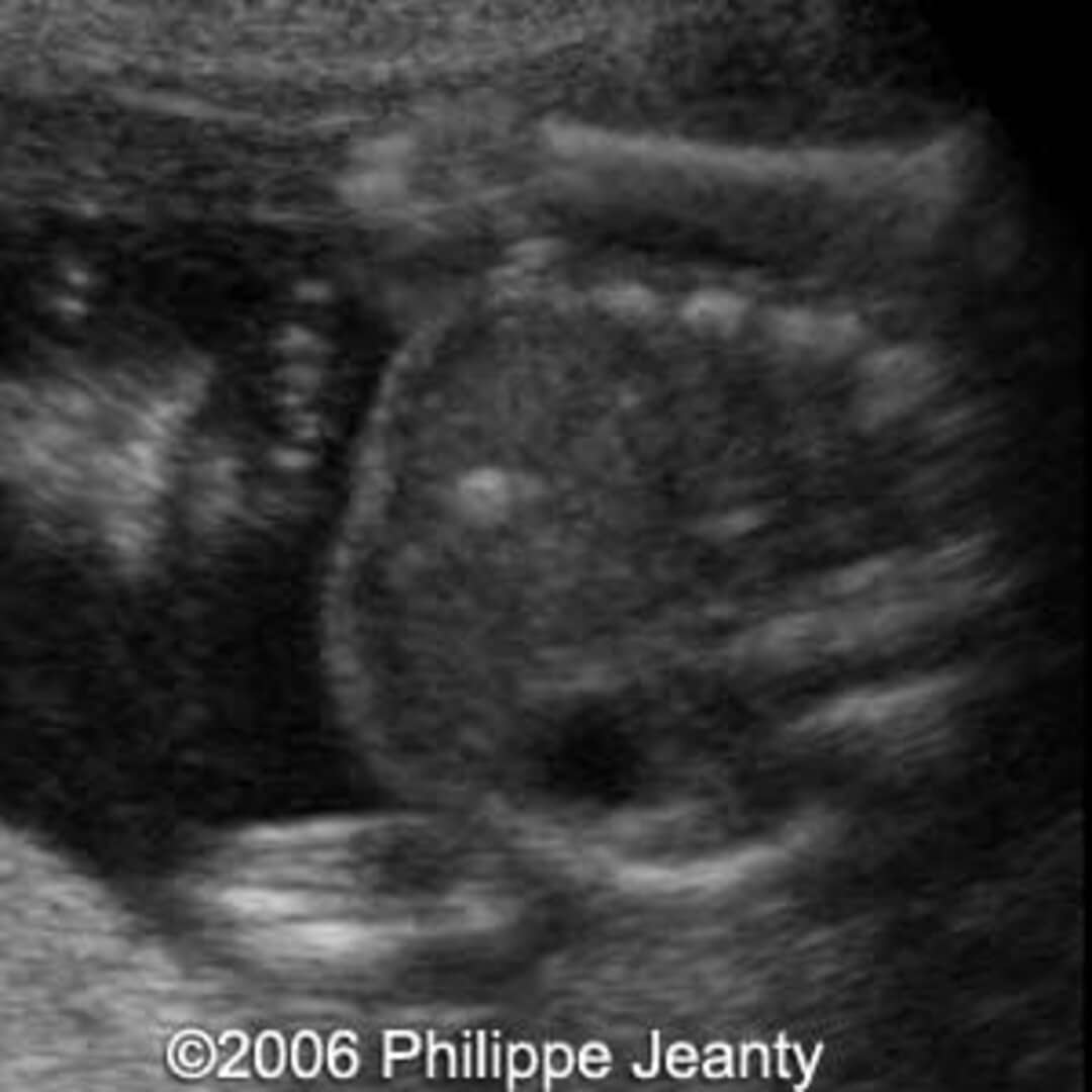 📃 Hepatic calcifications
