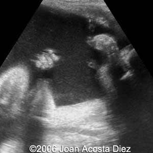 📃 Overlapping fingers