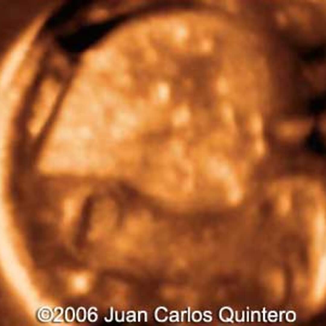 📃 Hepatic calcifications