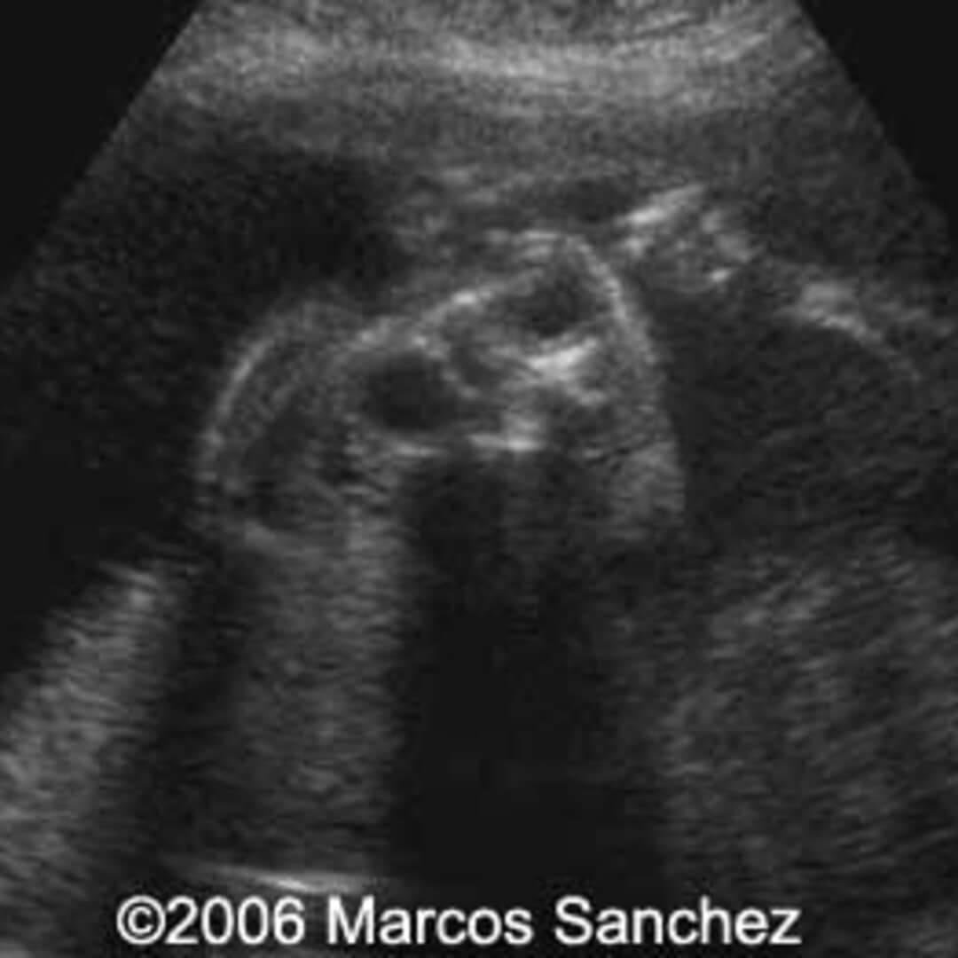 📃 Anencephaly