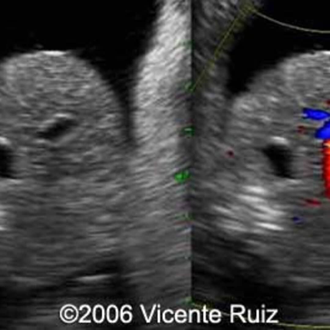 📃 Limb body stalk anomaly