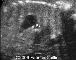 📃 Spleen calcifications