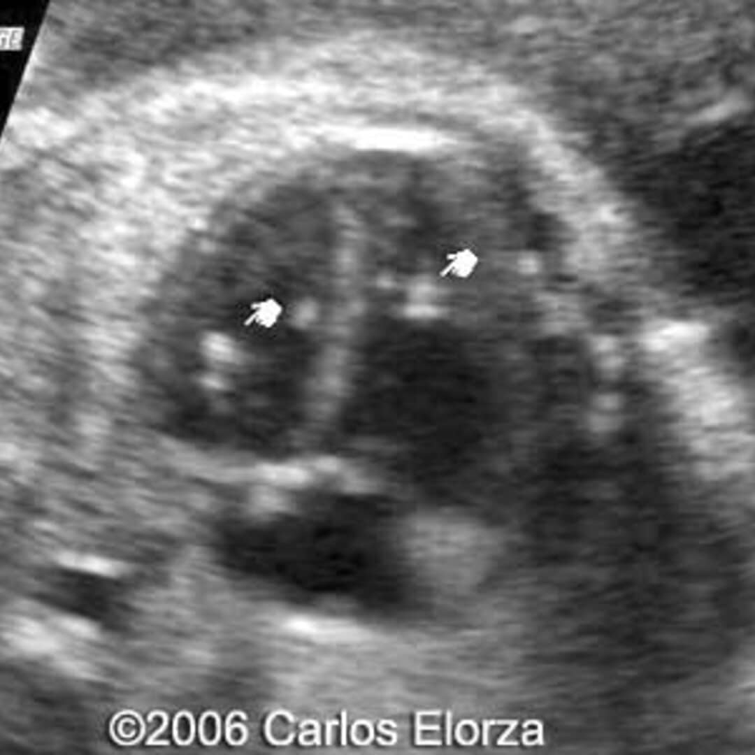 📃 Trisomy 13