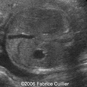 📃 Situs invertus, abdominal