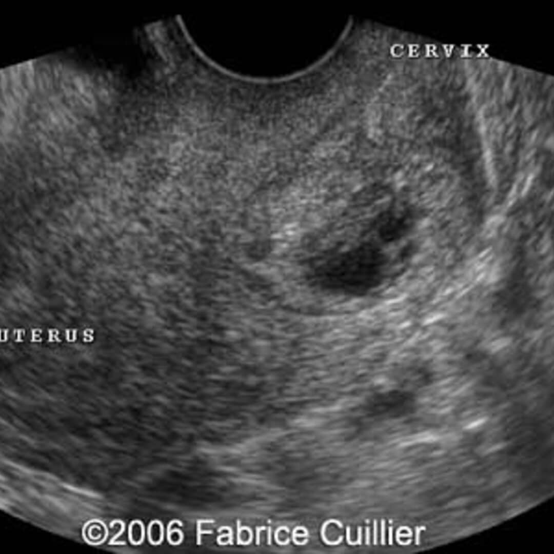 📃 Cervical pregnancy